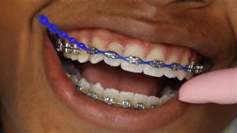 Common Questions About Braces Power Chains Answered - Power Chains Braces