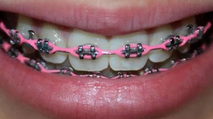 Power Chain Braces: How They Work and What to Expect